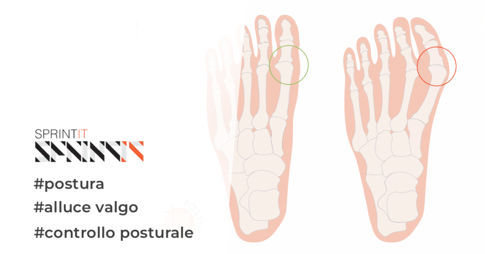 Alluce valgo: muscolo flessore lungo dell'alluce e controllo posturale ...